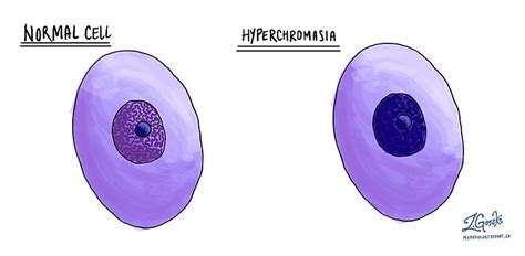 What Is Hyperchromasia Mypathologyreport
