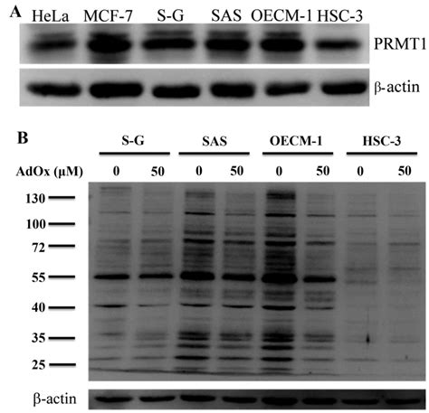 Prmt1 Expression Is Elevated In Head And Neck Cancer And Inhibition Of Protein Arginine