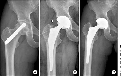 Figure 1 From Results Of Total Hip Arthroplasty After Core Decompression With Tantalum Rod For