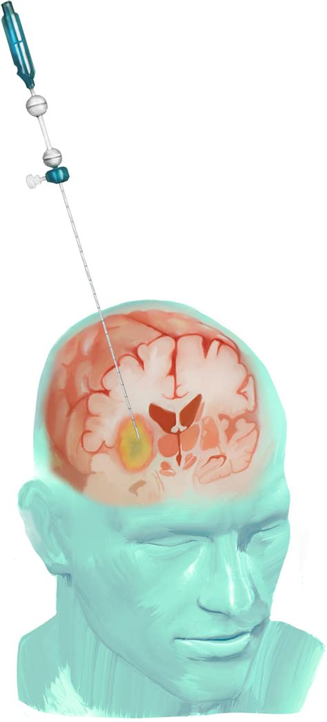 Artistic Rendering Of A Frameless Brain Biopsy Download Scientific