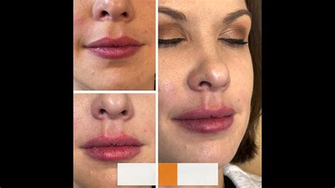 Restylane Kysse Lip Fillers Before And After Youtube