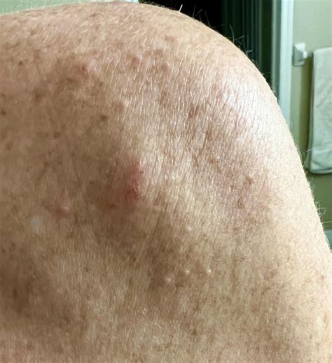Allergic Reaction Acne Rdermatologyquestions