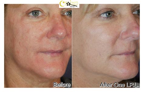 Intense Pulsed Light And Laser Therapies Charmed Medispa