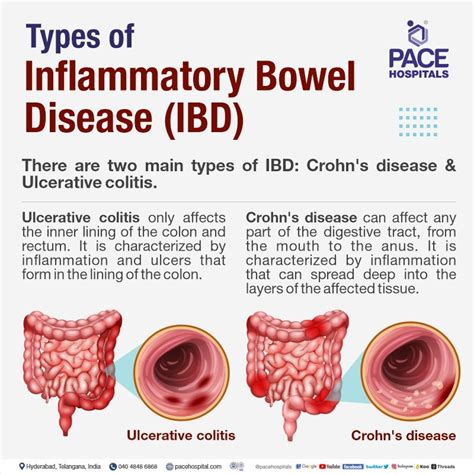 Inflammatory Bowel Disease IBD Symptoms Causes Treatment