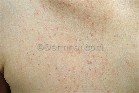 10 Best Images About Scleroderma On Pinterest Pictures Ems And Ps