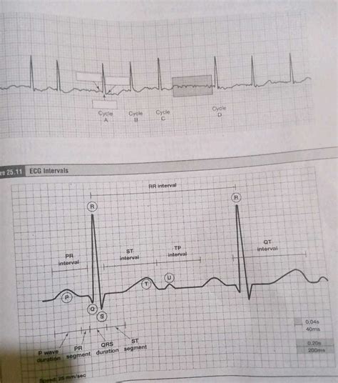 The Image Contains Two ECG Graphs The Top StudyX