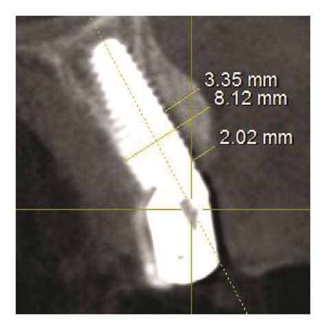 Cone Beam Computed Tomography Cbct Scans Of The Sites Before Surgery Download Scientific