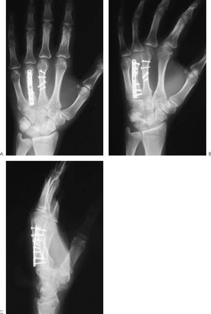 Metacarpal Shaft Fractures Musculoskeletal Key