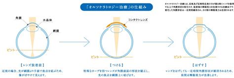 弱視斜視近視の抑制 診療案内 京都市中京区西ノ京の眼科医療法人さくらメディカル 円町さくら眼科クリニック