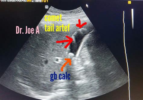 Ultrasound Imaging