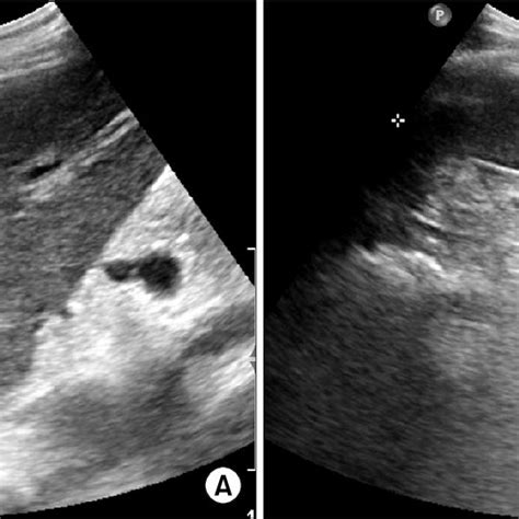 Liver Biopsy A Histologic Finding Many Immature Lymphocytes With