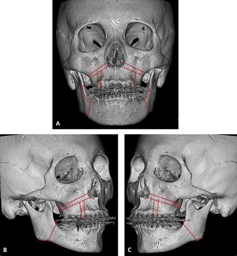 Excessive Gingival Display Treated With 2 Piece Segmental Le Fort I Osteotomy The Journal Of