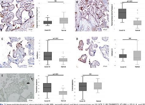 Figure 2 From Evidence Of Placental Villous Inflammation And Apoptosis
