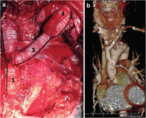 A Intraoperative View 1 Vascular Prosthesis From Ascending Aorta