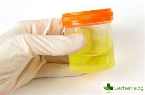 ᐉ Какво означава бялата в утайка в урината — Lechenie Bg