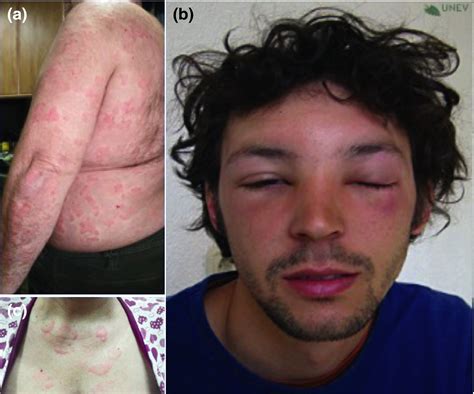 Idiopathic Urticaria