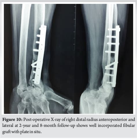 Giant Cell Tumor Of Distal Radius Treated With Wide Local Excision And