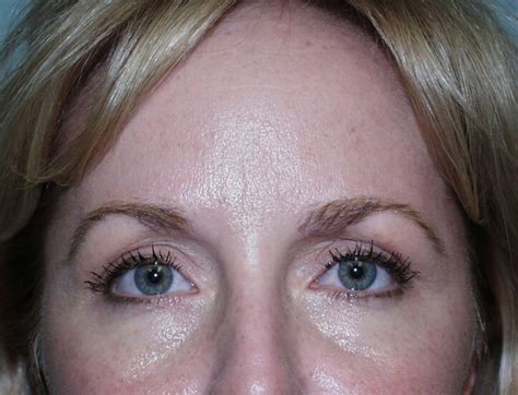 Botulinum Toxin Before And After Photos By Richard Greco Md Savannah