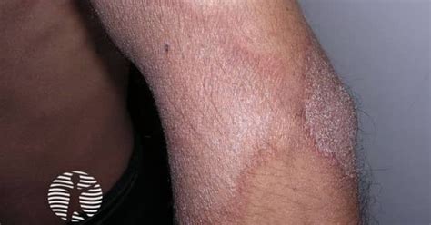 Erythrokeratoderma Image