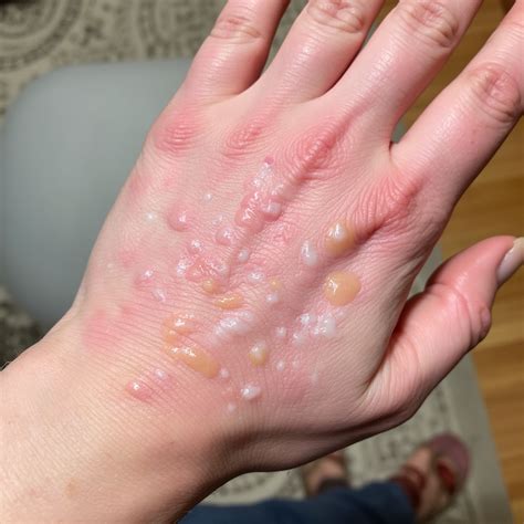 مراحل ترمیم زخم سوختگی و مراقب های ضروری