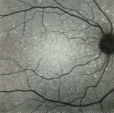 A Light In The Darc Seeing Glaucoma Before It Strikes