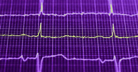 What Is Electrocardiography Ekgecg