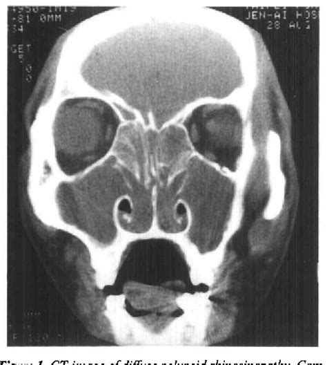 Figure 1 From Clinical Evaluation Of Maxillary Diffuse Polypoid Sinusitis After Functional