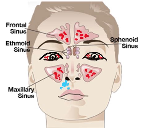 Common Cold Vs Allergic Rhinitis At Jacob Byrd Blog