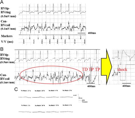 Inappropriate Detection During Atrial Fibrillation A Immediately