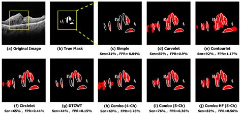 Diagnostics Free Full Text Optimal Deep Learning Architecture For Automated Segmentation Of