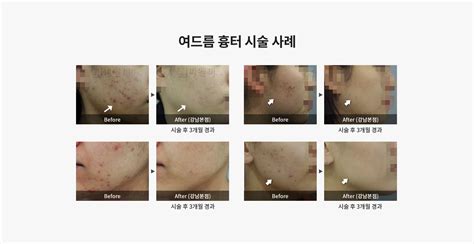 강남여드름흉터 강남역여드름흉터