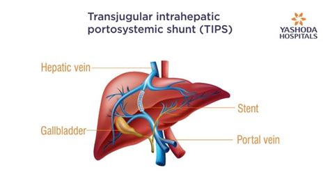 Tips Transjugular Intrahepatic Portosystemic Shunt And Portal