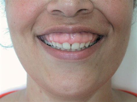 Gingivectomy Cost Healing Process And The Procedure