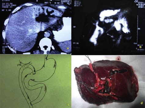 Figure 1 From Outcome Of Surgery For Recurrent Pyogenic Cholangitis A
