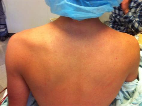Kevins Shoulder Saga Uw Orthopaedics And Sports Medicine Seattle