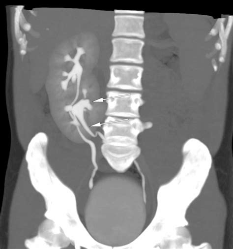 Normal Variants Radiology Cafe
