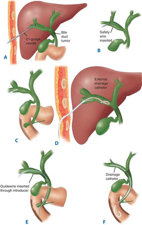 Percutaneous Transhepatic Drainage Of Gallbladder Best Drain Photos