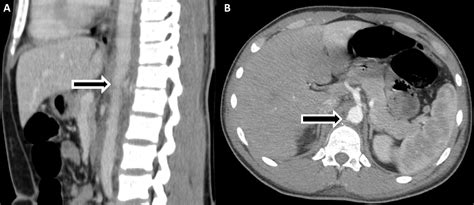 SAVS Traumatic Aortic Pseudoaneurysm With Bullet Embolism Following Multiple Gun Shot Wounds