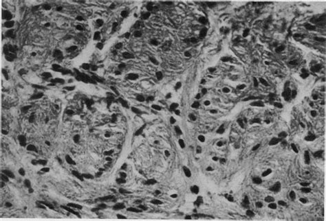 Testicular Biopsy Showing Diffuse Interstitial Fibrosis Tubular