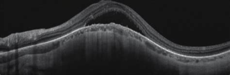 Sd Oct Showing A Dome Shaped Macula Download Scientific Diagram