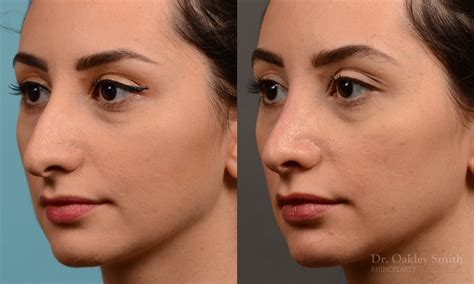 Rhinoplasty Before And After Case 299 Toronto Rhinoplasty Surgery