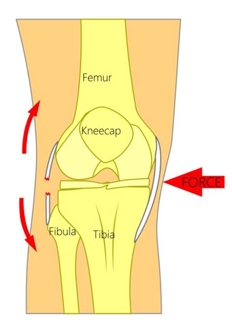 Lateral Collateral Ligament Lcl Tears Upswing Health Upswing Health In 2025 Ligament