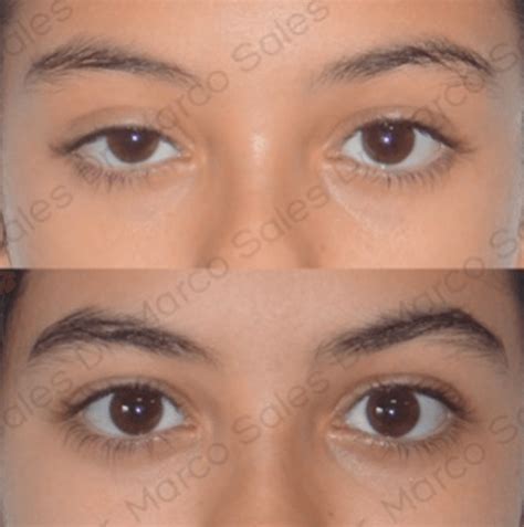 Ptosis Palpebral Dr Marco Sales