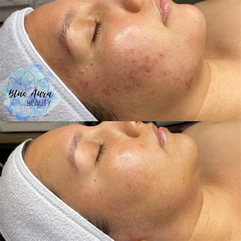 Chemical Peel For Acne Scars All You Need To Know