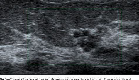Figure 162 From Atypical Ductal Hyperplasia Diagnosed At