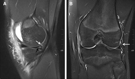 前交叉韧带撕裂患者的前外侧韧带撕裂和坡道损伤的频率以及表明这些损伤的相关损伤——回顾性 Mri 分析 European Radiology X Mol