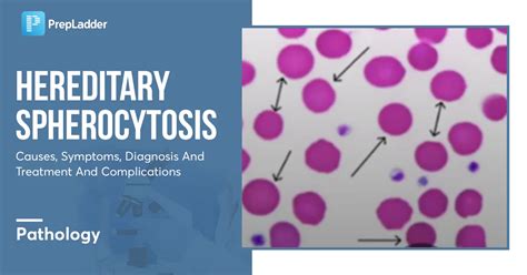 Hereditary Spherocytosis Causes Symptoms Treatment
