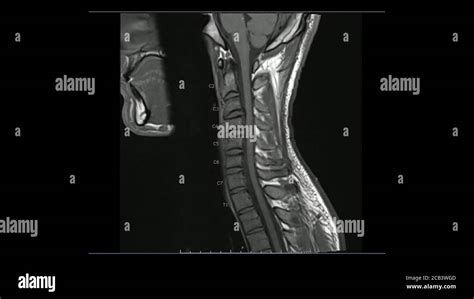 Magnetic Resonance Images Of Cervical Spine Sagittal T1 Weighted Image