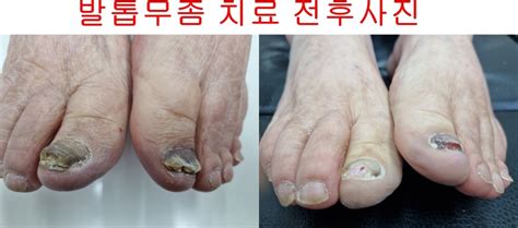 발톱무좀 내성발톱 실비가능 소중한나피부과