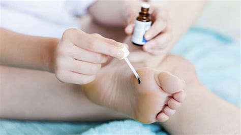 Plantar Warts 10 Home Remedies For Plantar Warts
